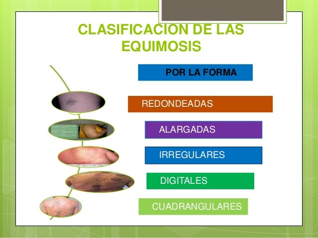 Valoracion medico legal equimosis hematomas