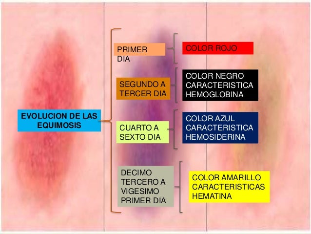 Valoracion medico legal equimosis hematomas