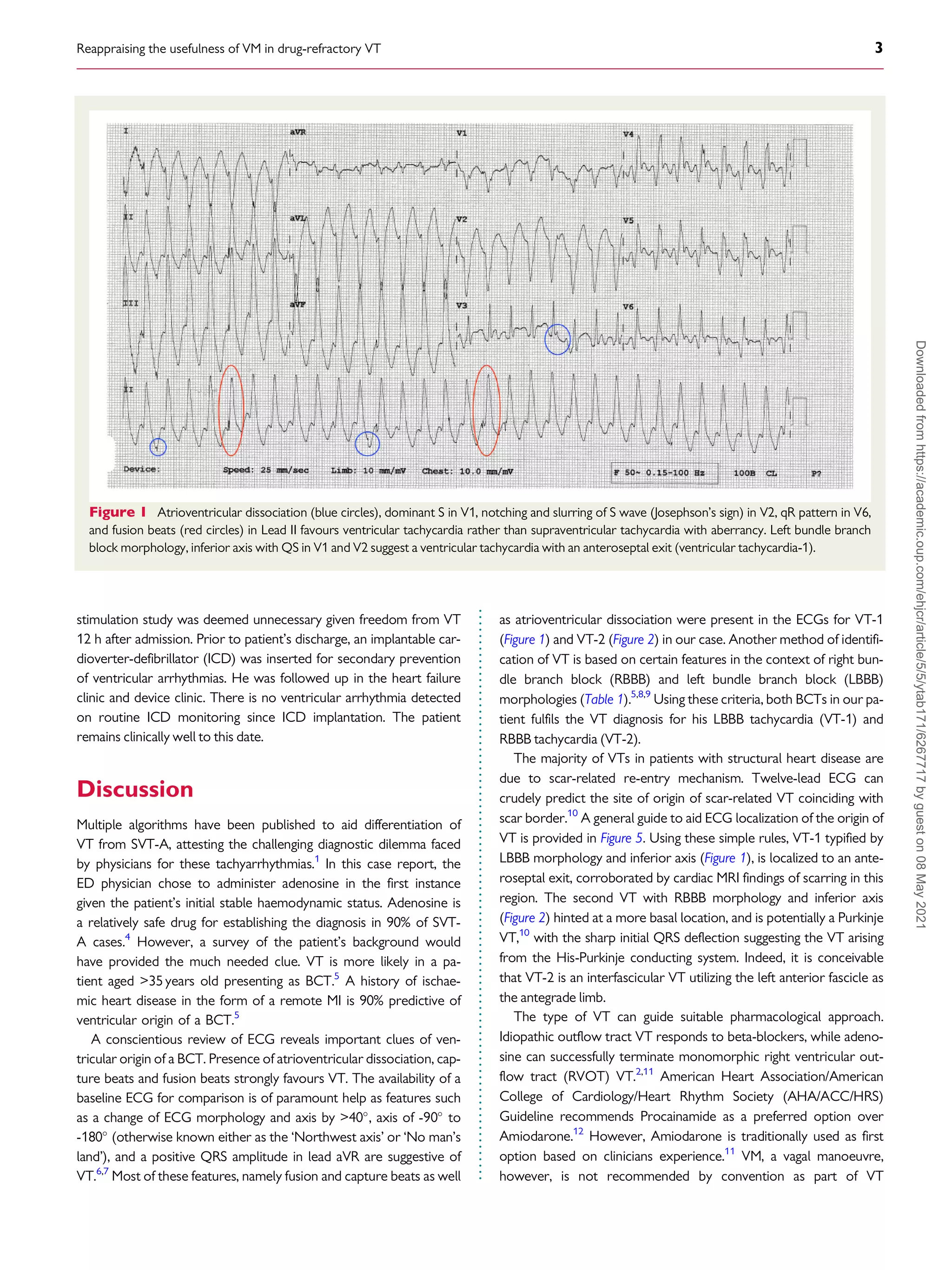 Valsalva manoeuvre in drug refractory ventricular tachycardia | PDF