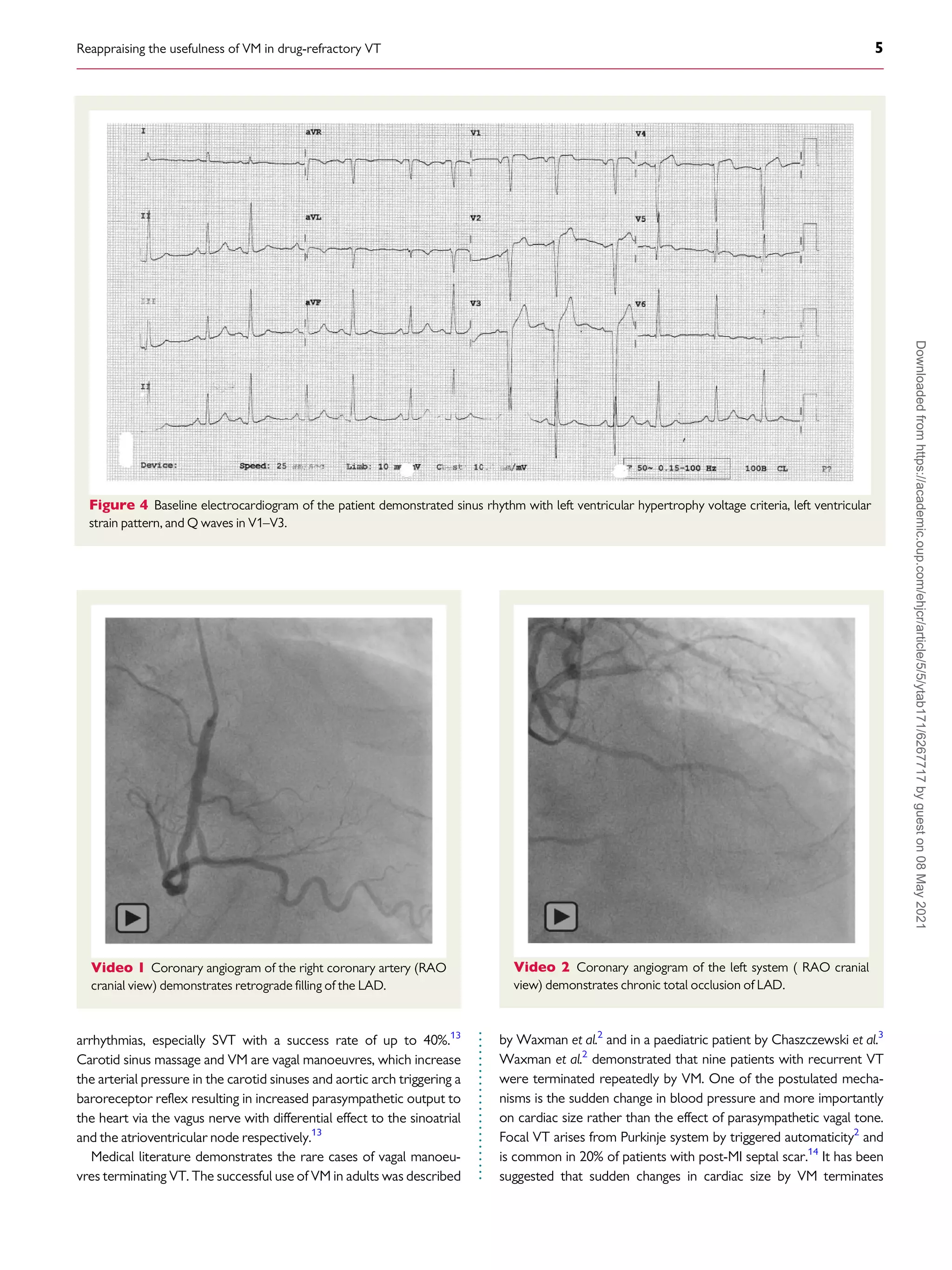 Valsalva manoeuvre in drug refractory ventricular tachycardia | PDF