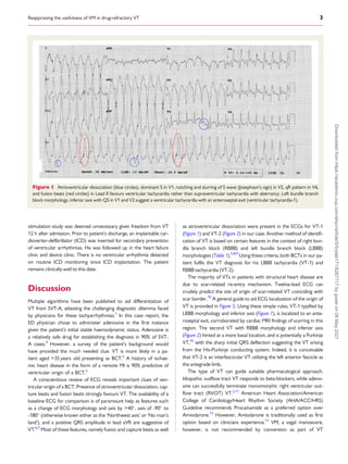 Valsalva manoeuvre in drug refractory ventricular tachycardia | PDF