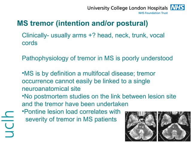Management of tremor and spasticity in MS | PPT | Physical Therapy ...