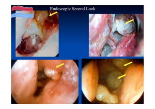 Value Of Ear Endoscopy In Cholesteatoma Surgery.Ppt