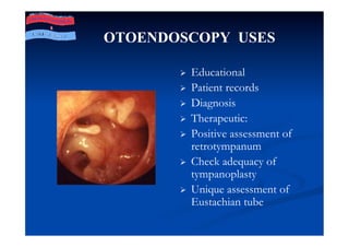 Value Of Ear Endoscopy In Cholesteatoma Surgery.Ppt