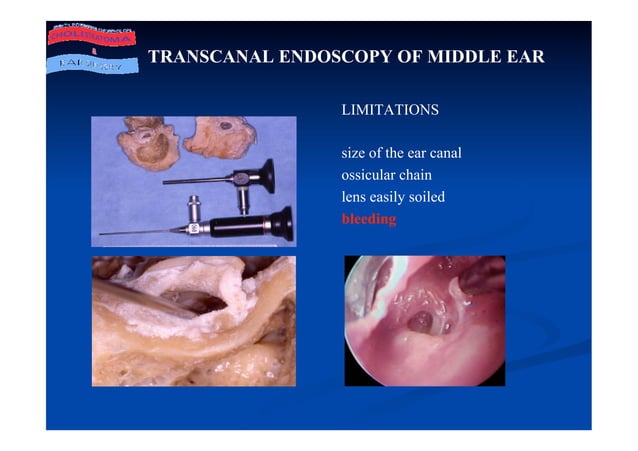 Value Of Ear Endoscopy In Cholesteatoma Surgery.Ppt | Ear, Nose and ...