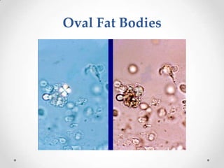 Oval Fat Bodies Urine Protein
