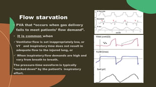Value of ventilator mode and interface in regulating patient ventilator ...