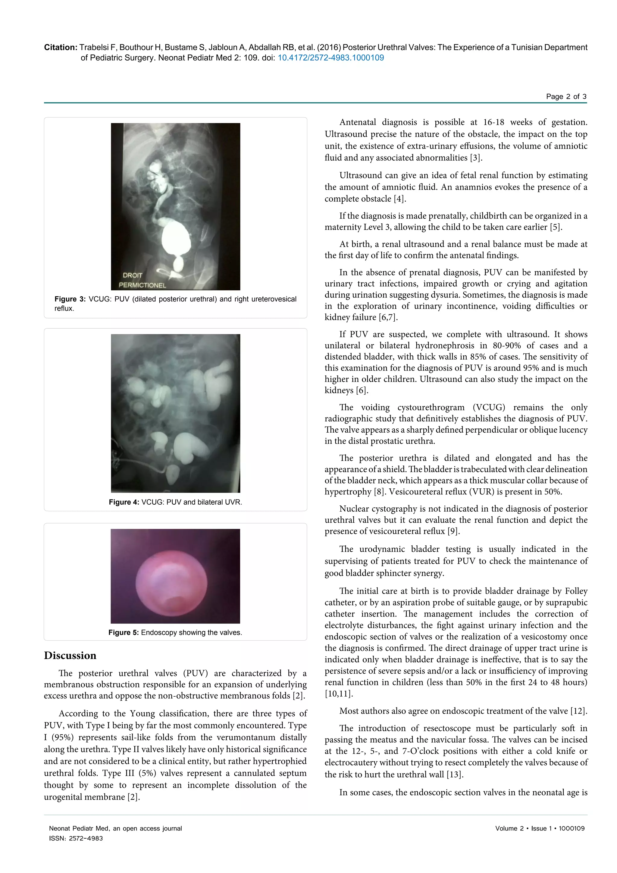 Valvas de uretra posterior | PDF