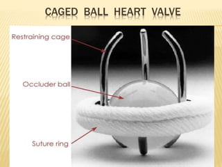 HEART VALVE | PPTX