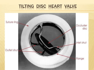 HEART VALVE | PPTX