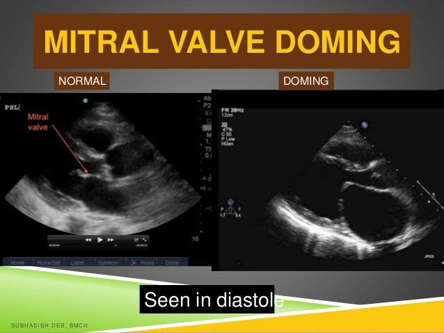 Valve replacement therapy in heart diseases in adults