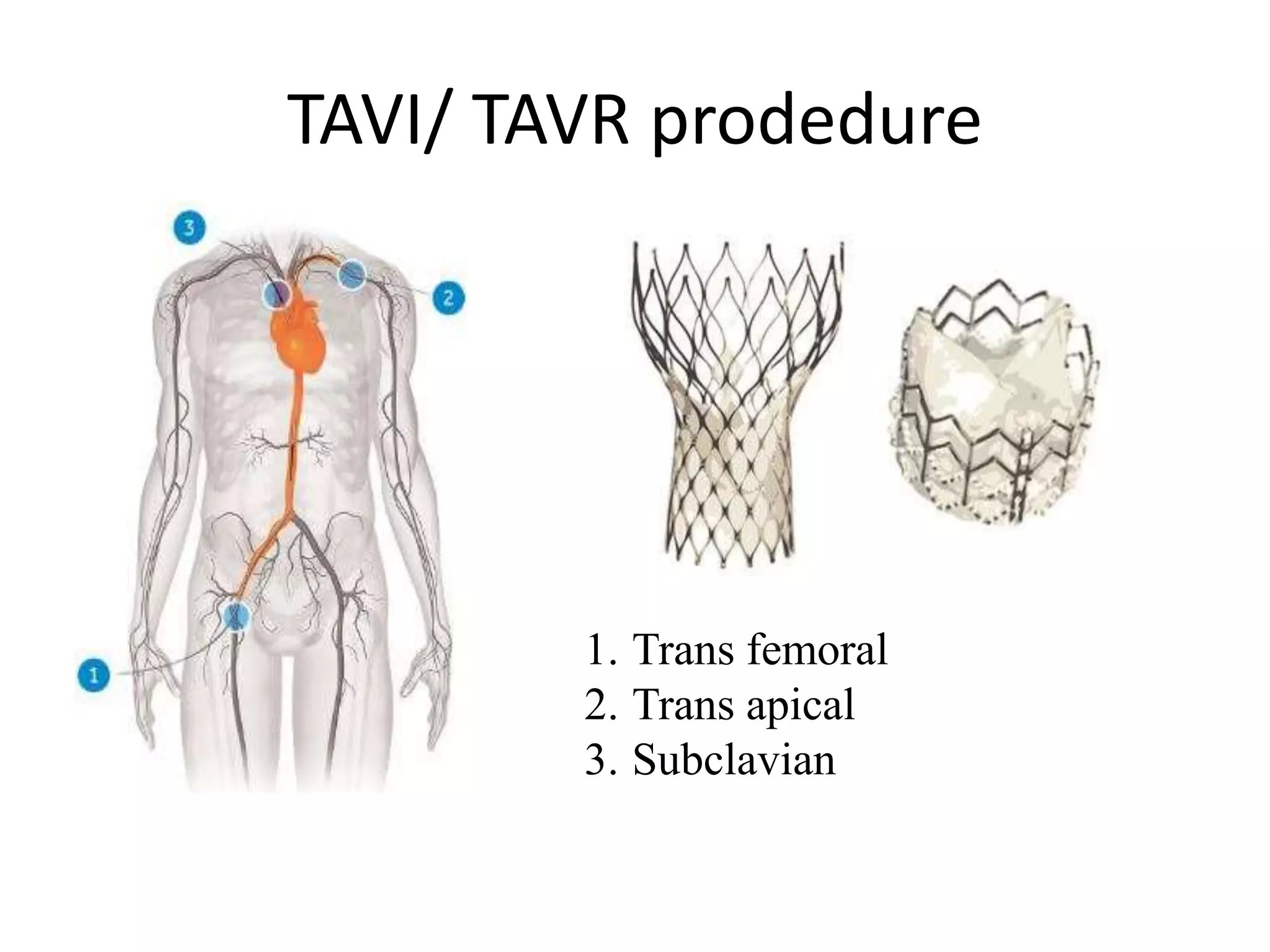 Valve transplant and its nursing management | PPTX