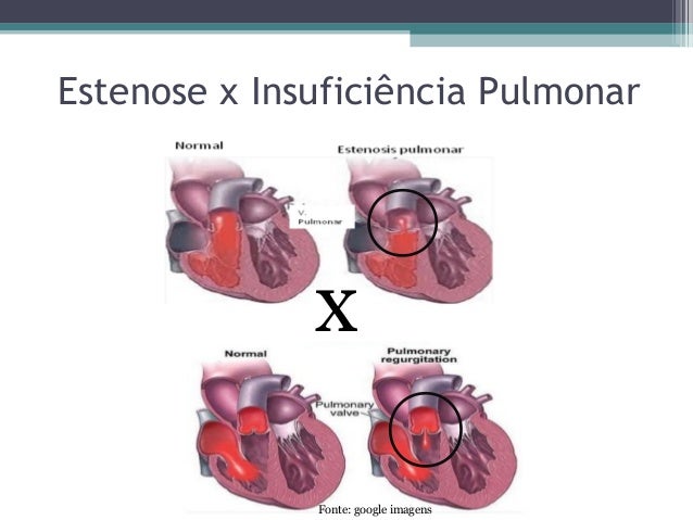 Valvopatias semilunares