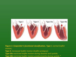 Valvula mitral conroversias | PPT