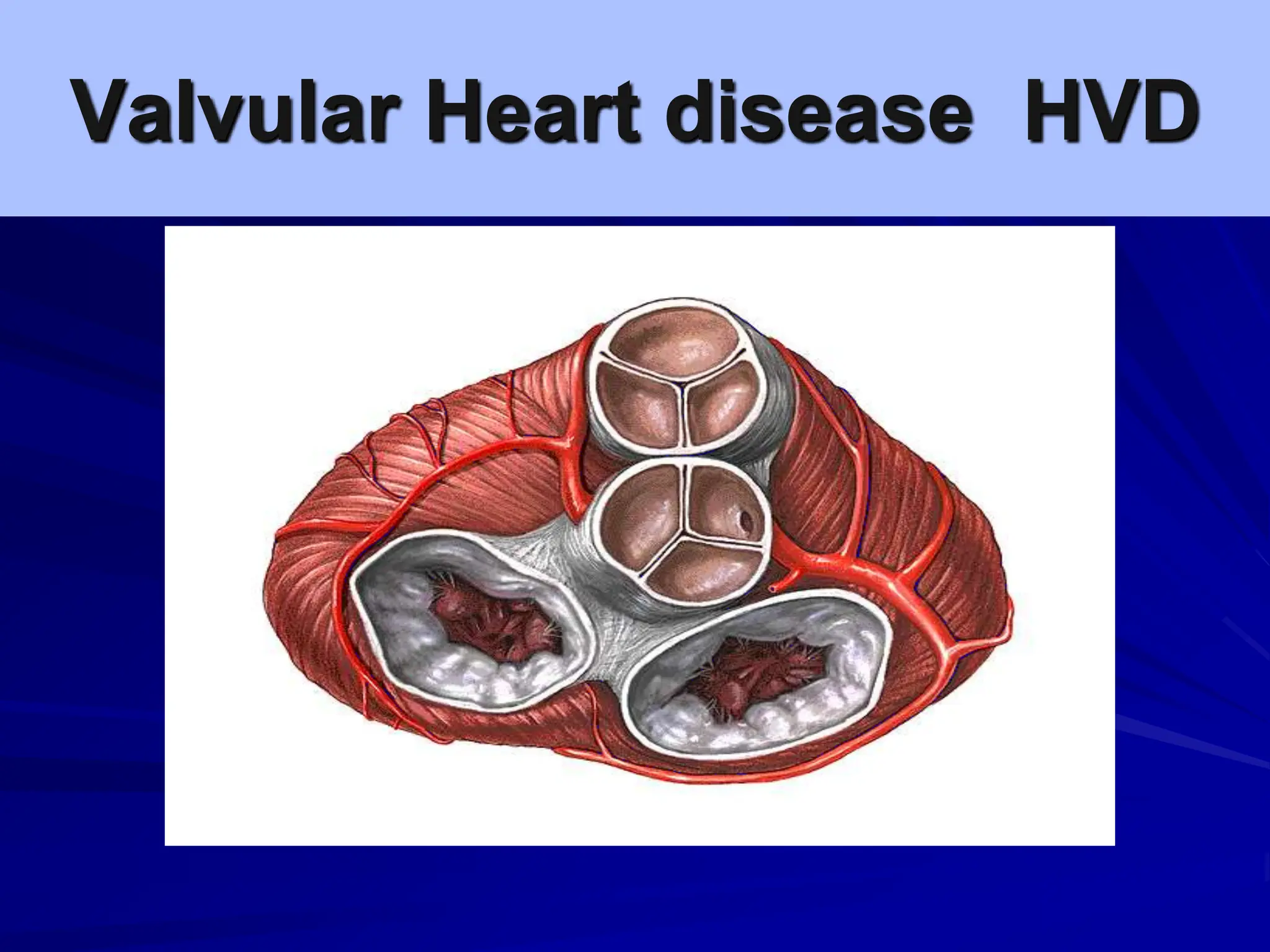 Valvular disease.ppt