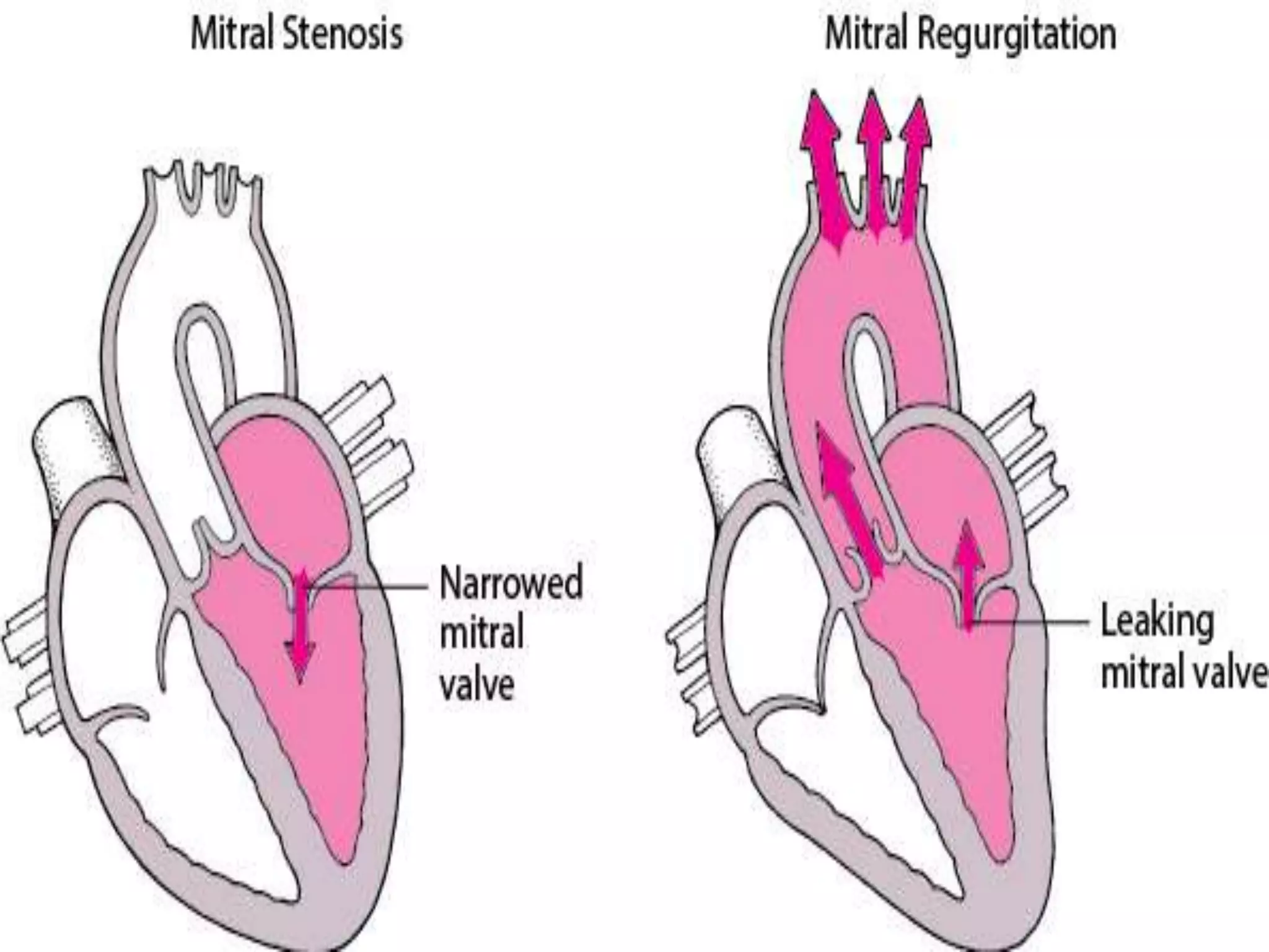 valvular disorder.pptx