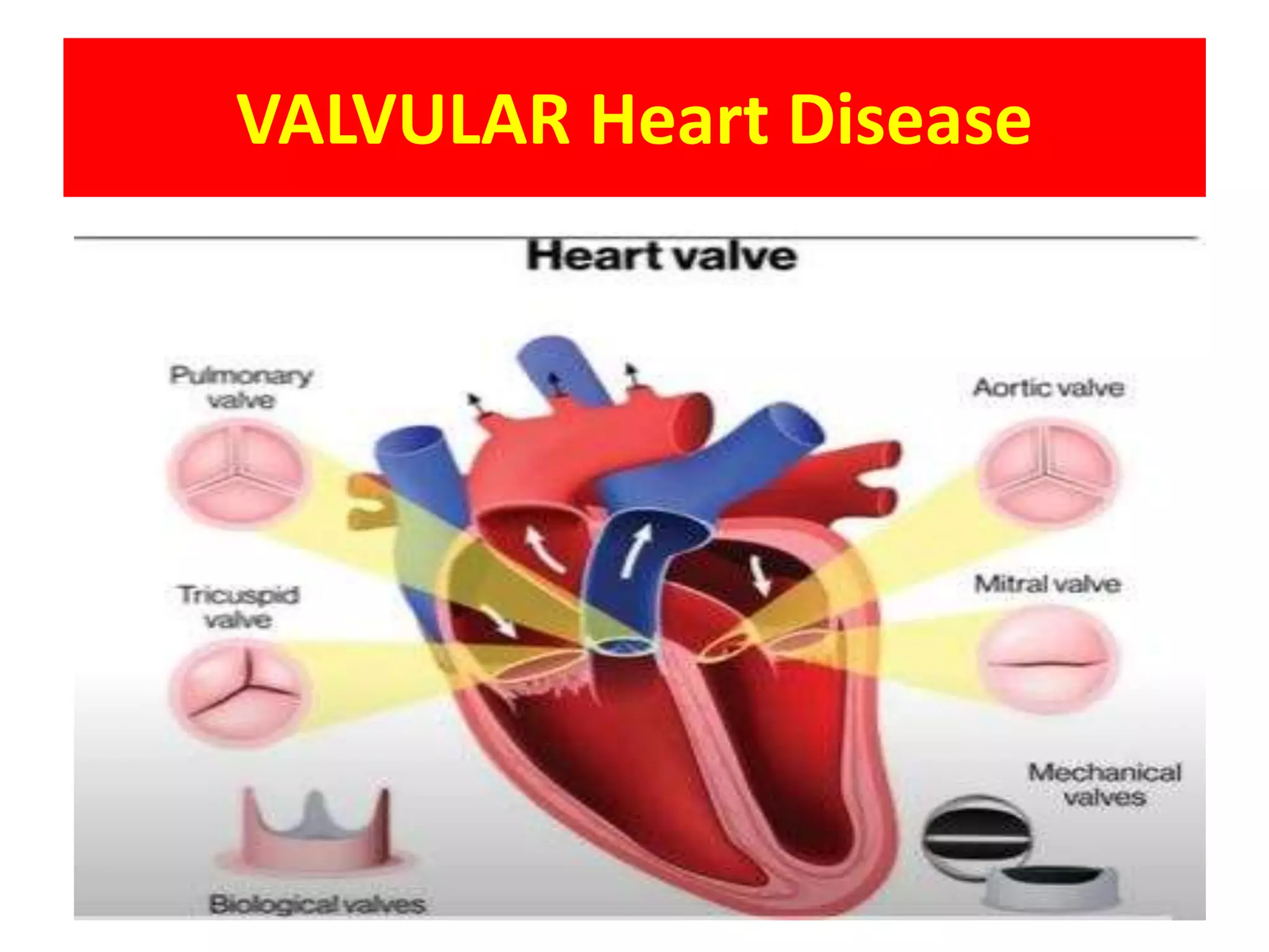 Valvular Heart Ddisease- MS.pptx