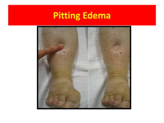 Valvular Heart Ddisease- MS.pptx