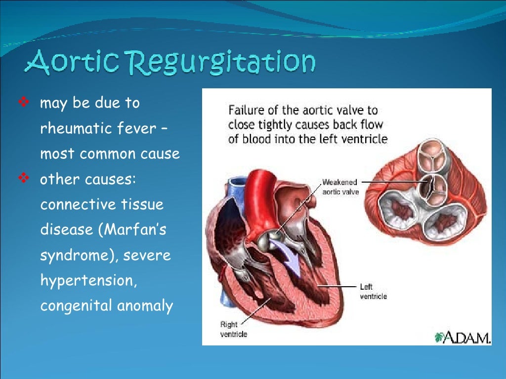 valvular-heart-disease