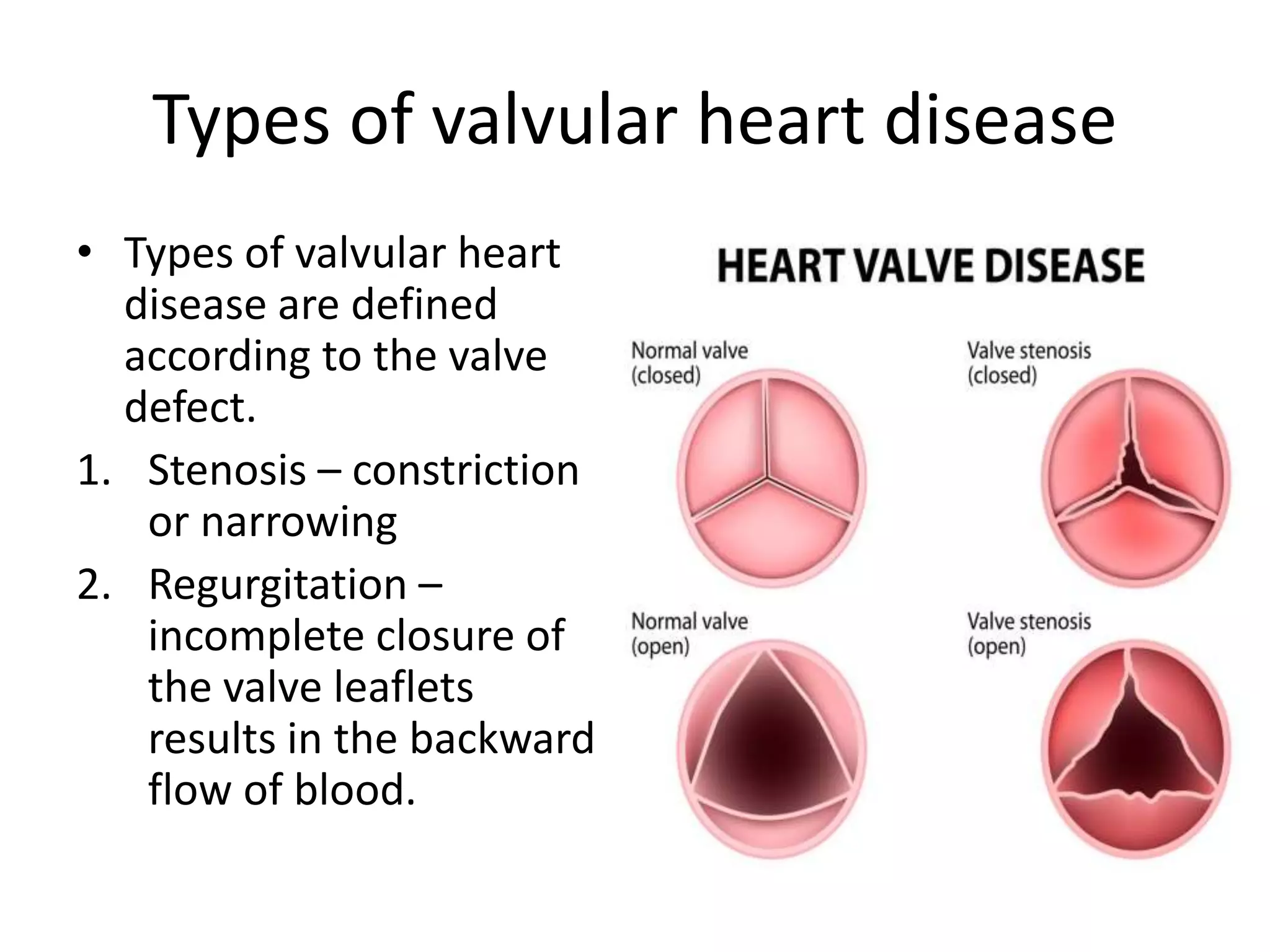 Valvular heart disease | PPTX