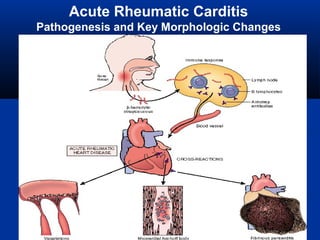 Valvular heart disease | PPT