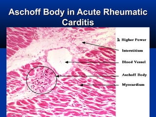 Valvular heart disease | PPT