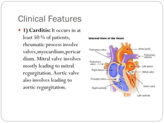 Valvular Heart Disease-1,Lecture 3 (1).pdf