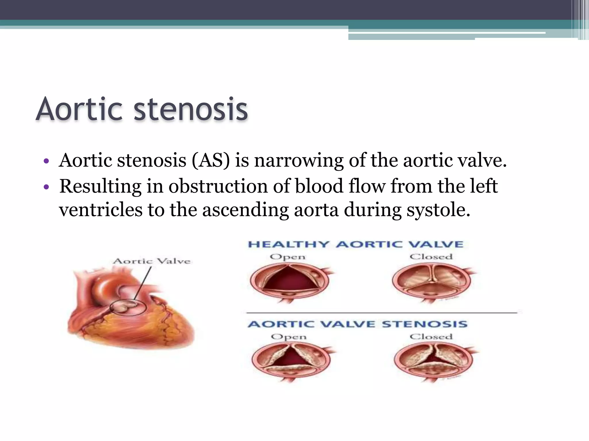 Valvular heart disease | PPTX | Heart and Cardiovascular Diseases ...
