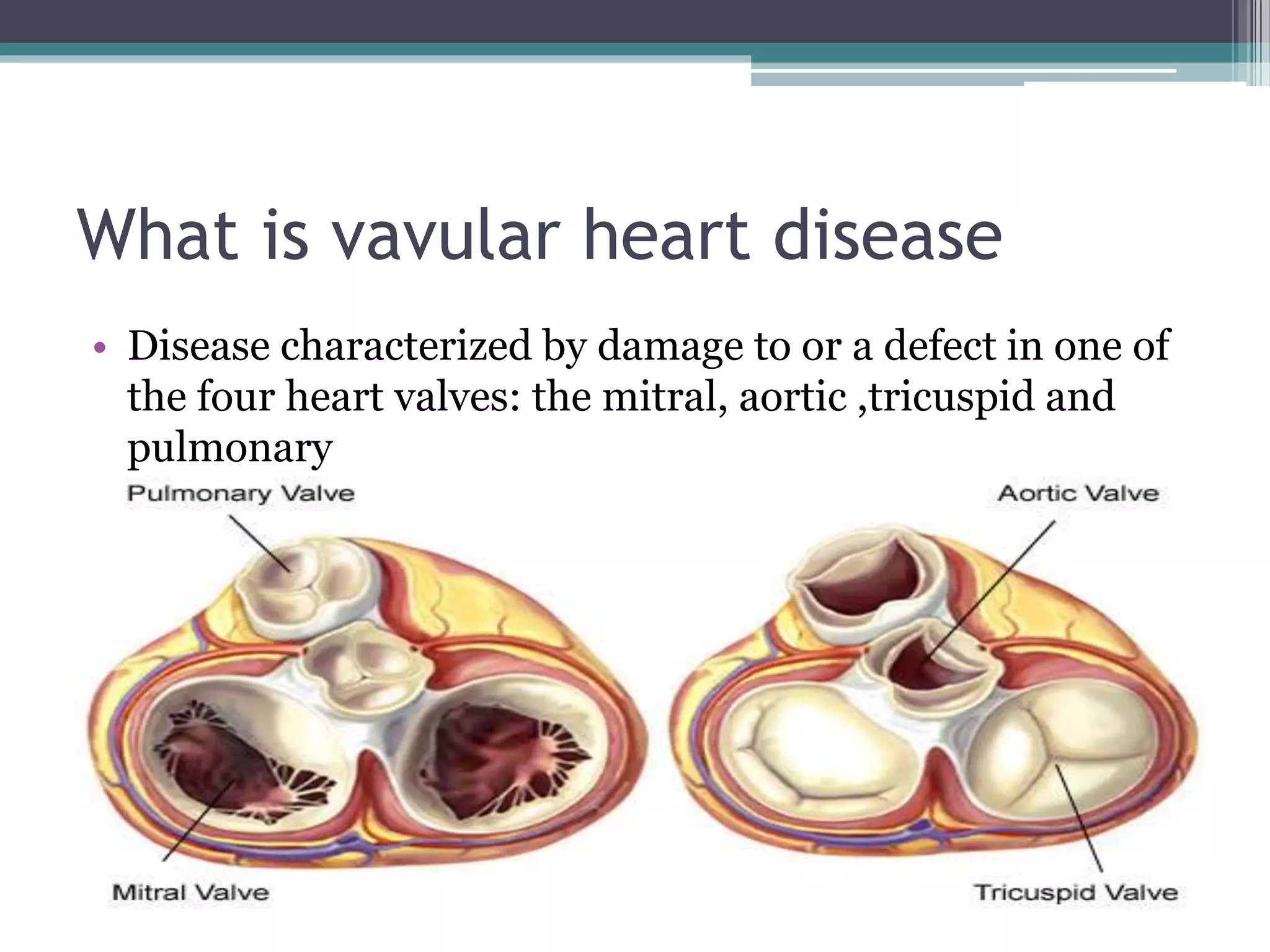 Valvular heart disease | PPTX | Heart and Cardiovascular Diseases ...