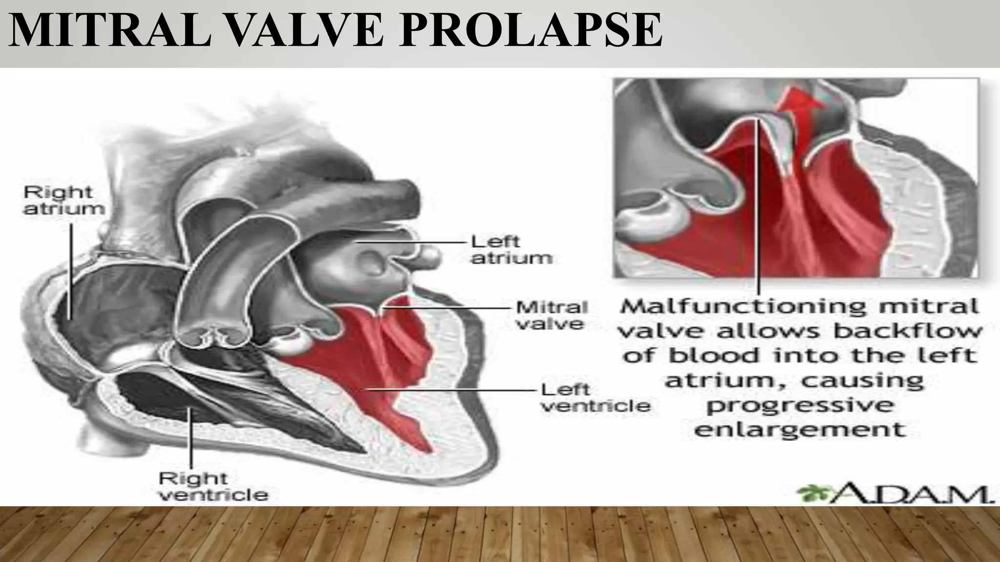 Valvular heart disease.pdf | Heart and Cardiovascular Diseases ...