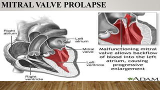 Valvular heart disease.pdf