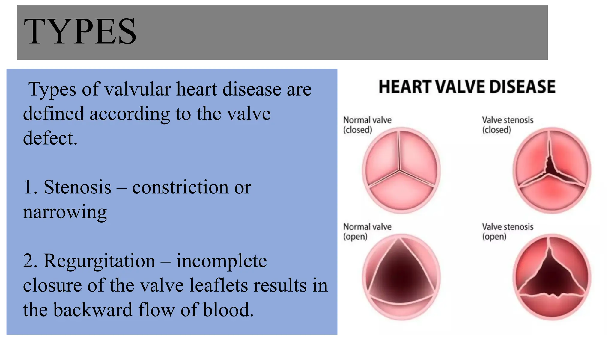valvular heart disease.pptx hkkgdssssgjkklkk | PPTX
