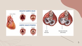 VALVULAR HEART DISEASE.pptx surgical indications, different surgical ...