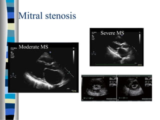 Valvular heart disease assessment of lesion severity | PPT