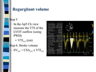 Valvular heart disease assessment of lesion severity | PPT