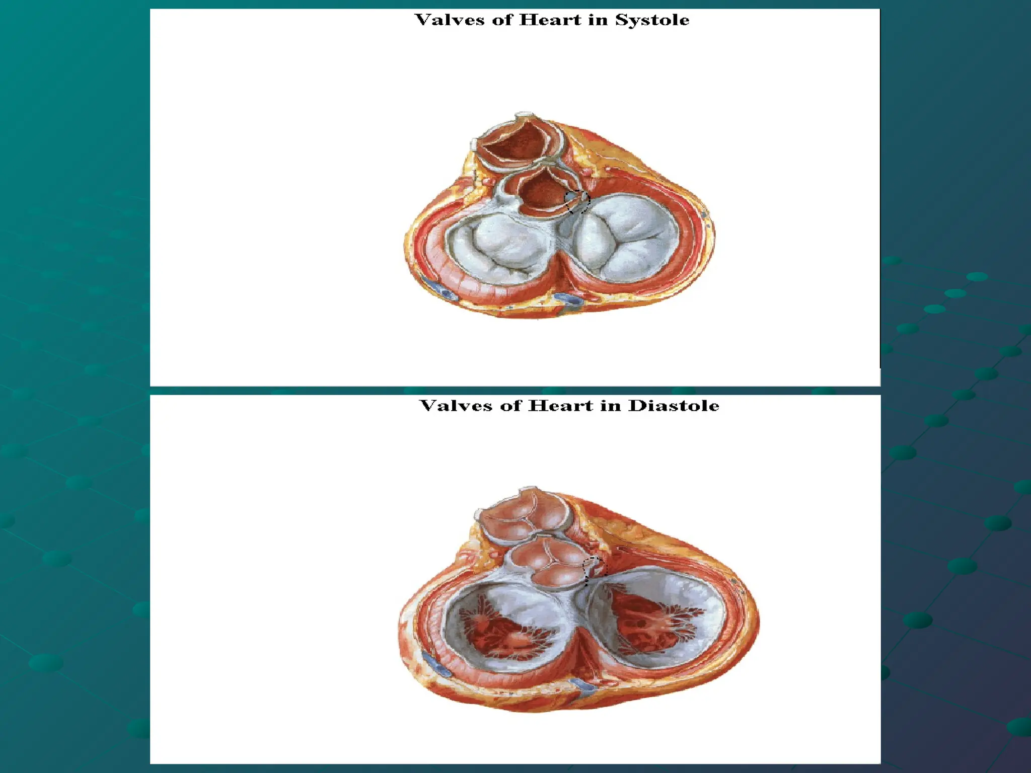 valvular heart disease anaesthesia considerations.ppt