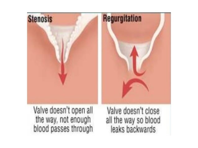 Valvular Heart Disease 1pdf