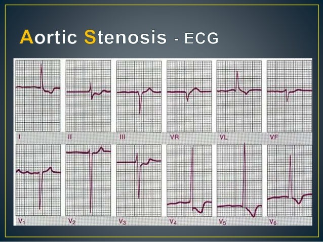Valvular heart disease