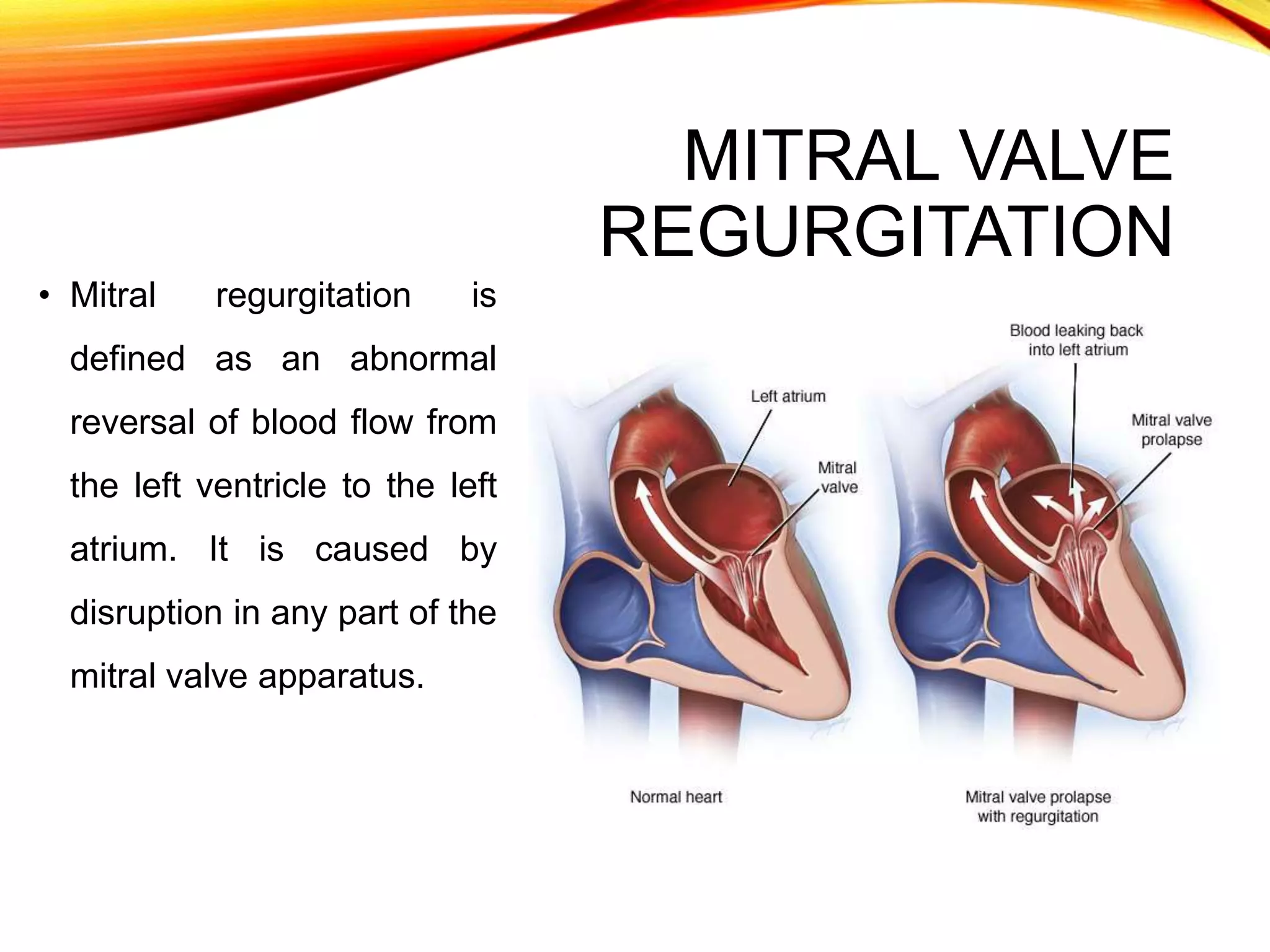 Valvular Heart Diseases | PPTX