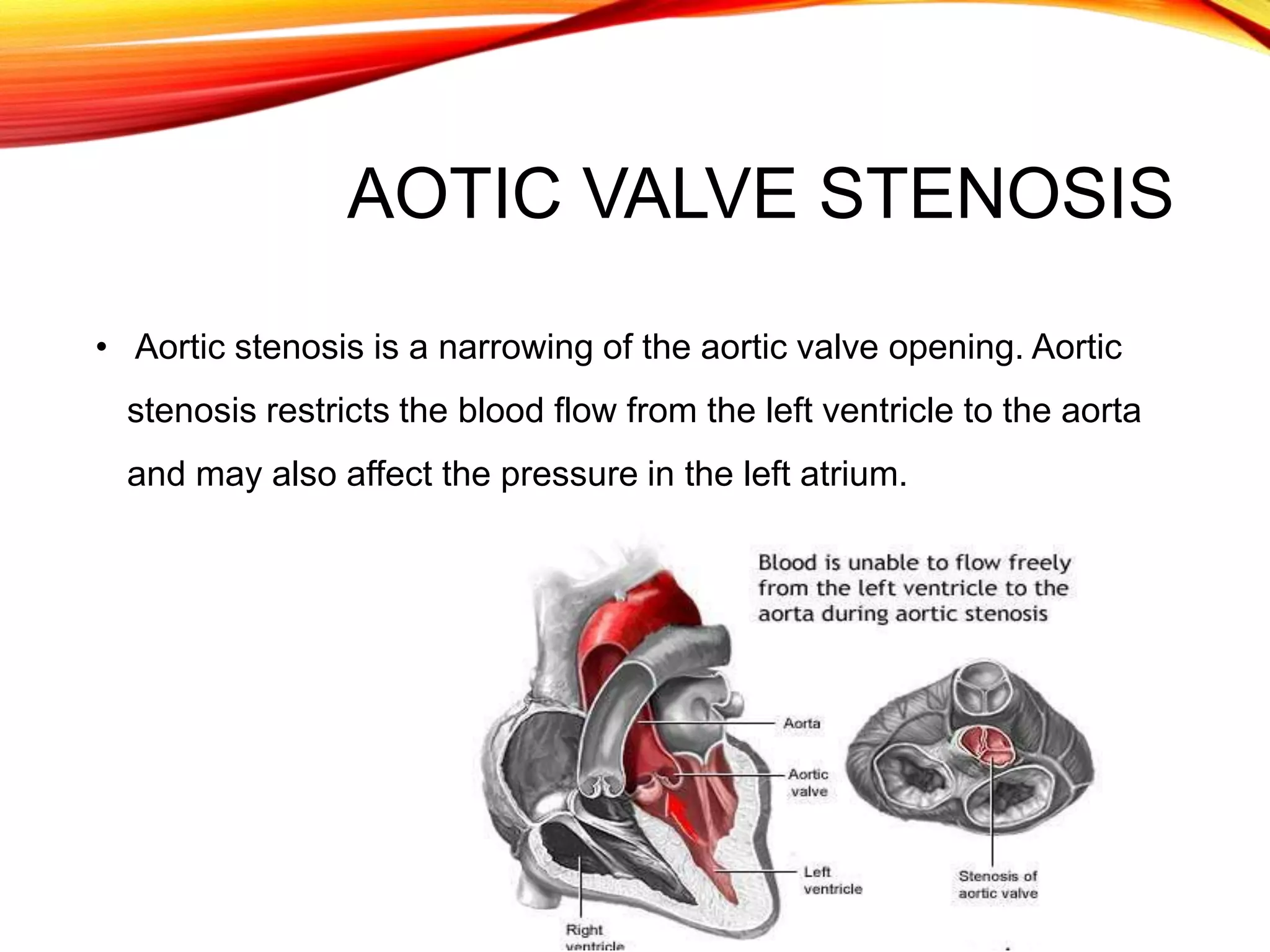 Valvular Heart Diseases | PPTX