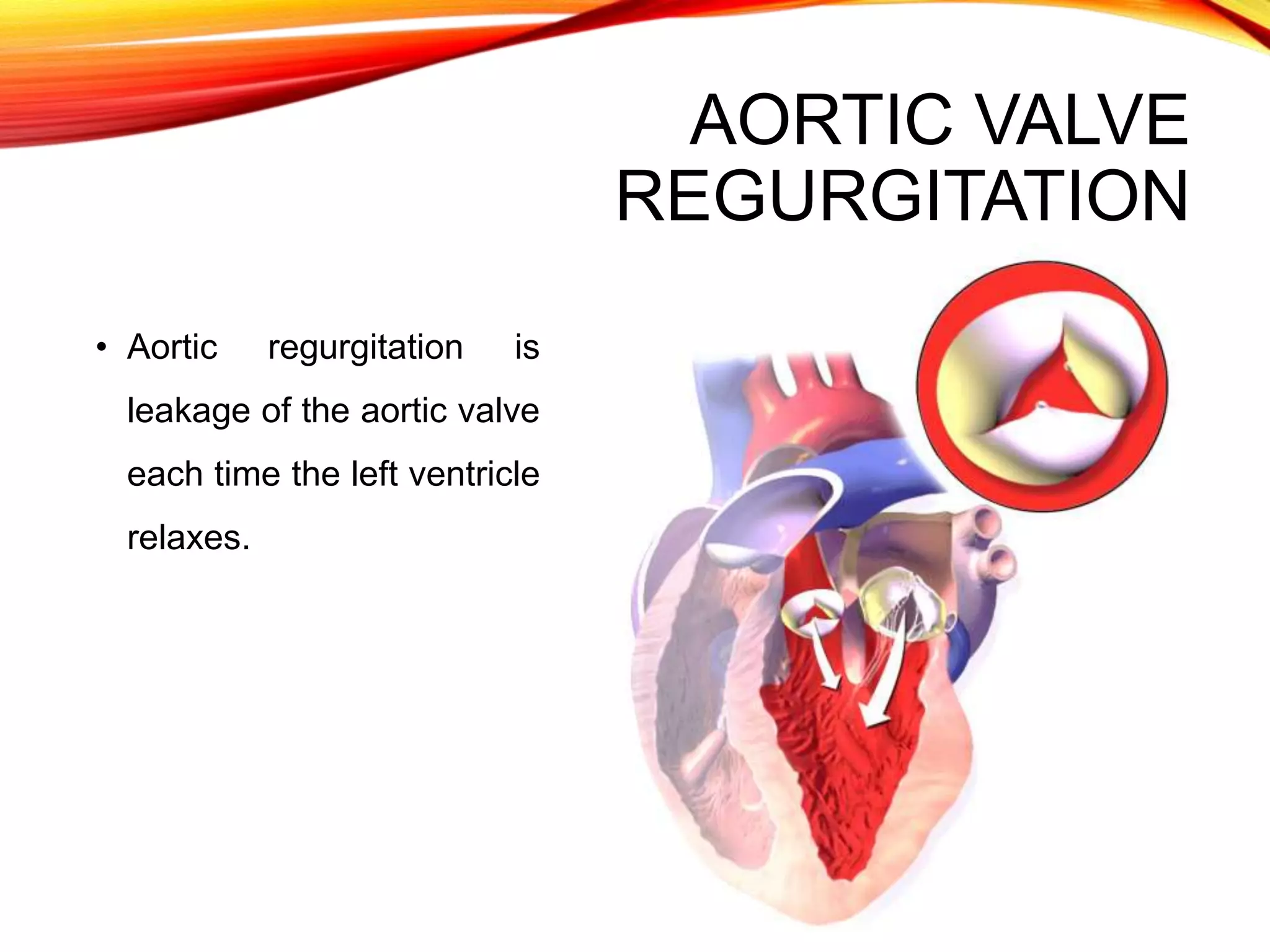Valvular Heart Diseases | PPTX