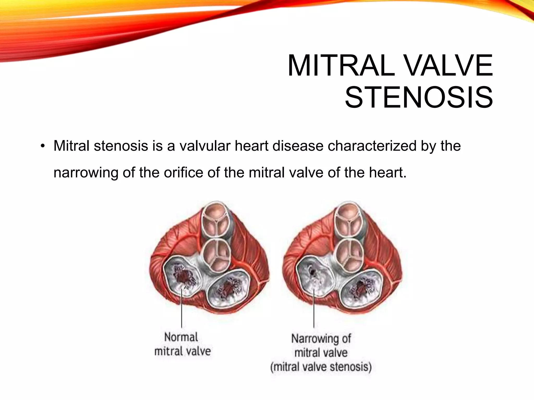 Valvular Heart Diseases | PPTX