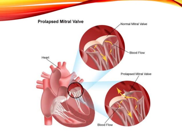 Valvular Heart Diseases | PPTX | Heart and Cardiovascular Diseases ...