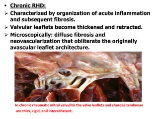 Valvular heart diseases 4 | PPTX