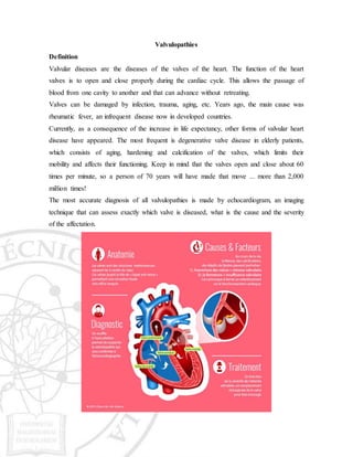 Valvulopathies | DOCX