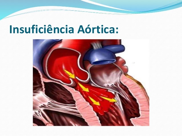 Insuficiência Mitral e Aortica