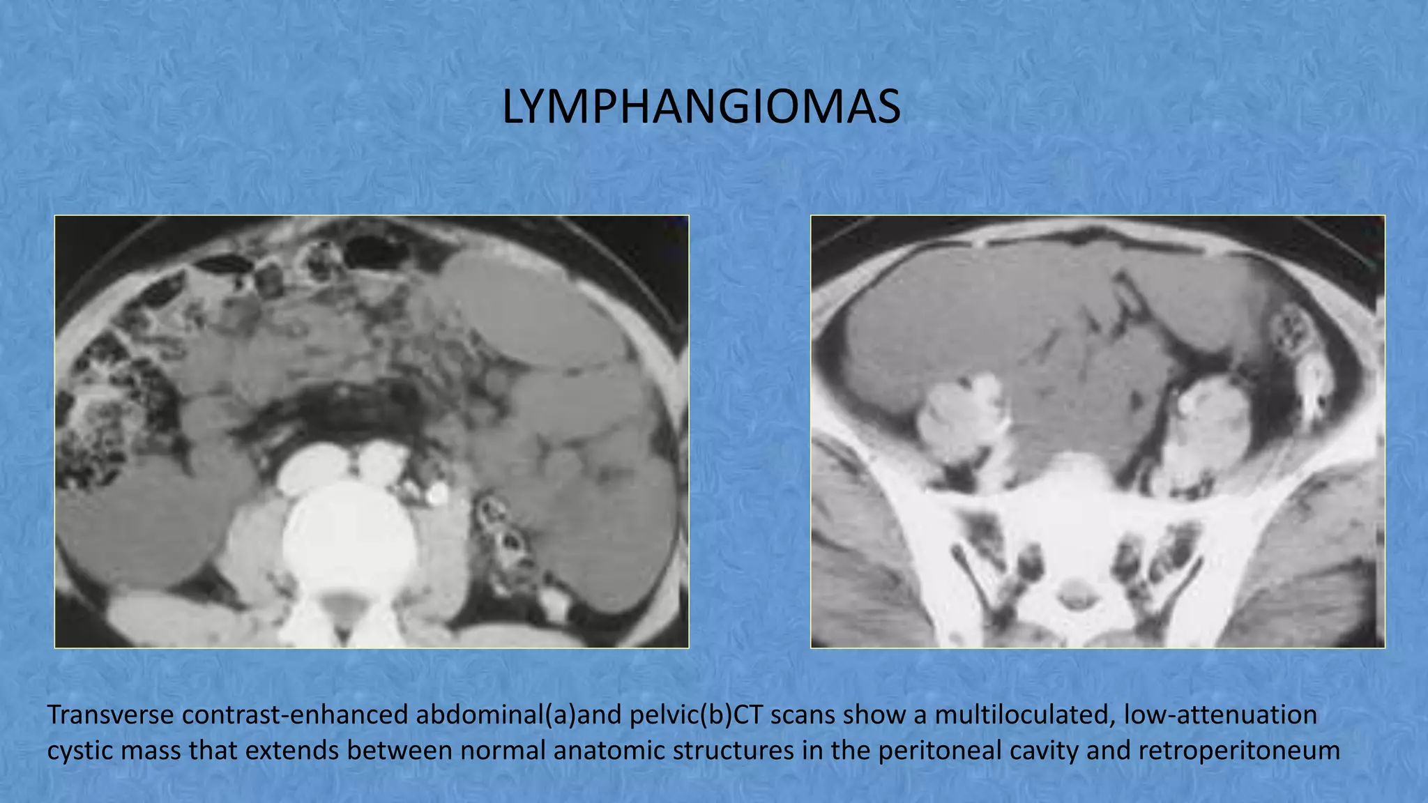 Retroperitoneal masses | PPTX