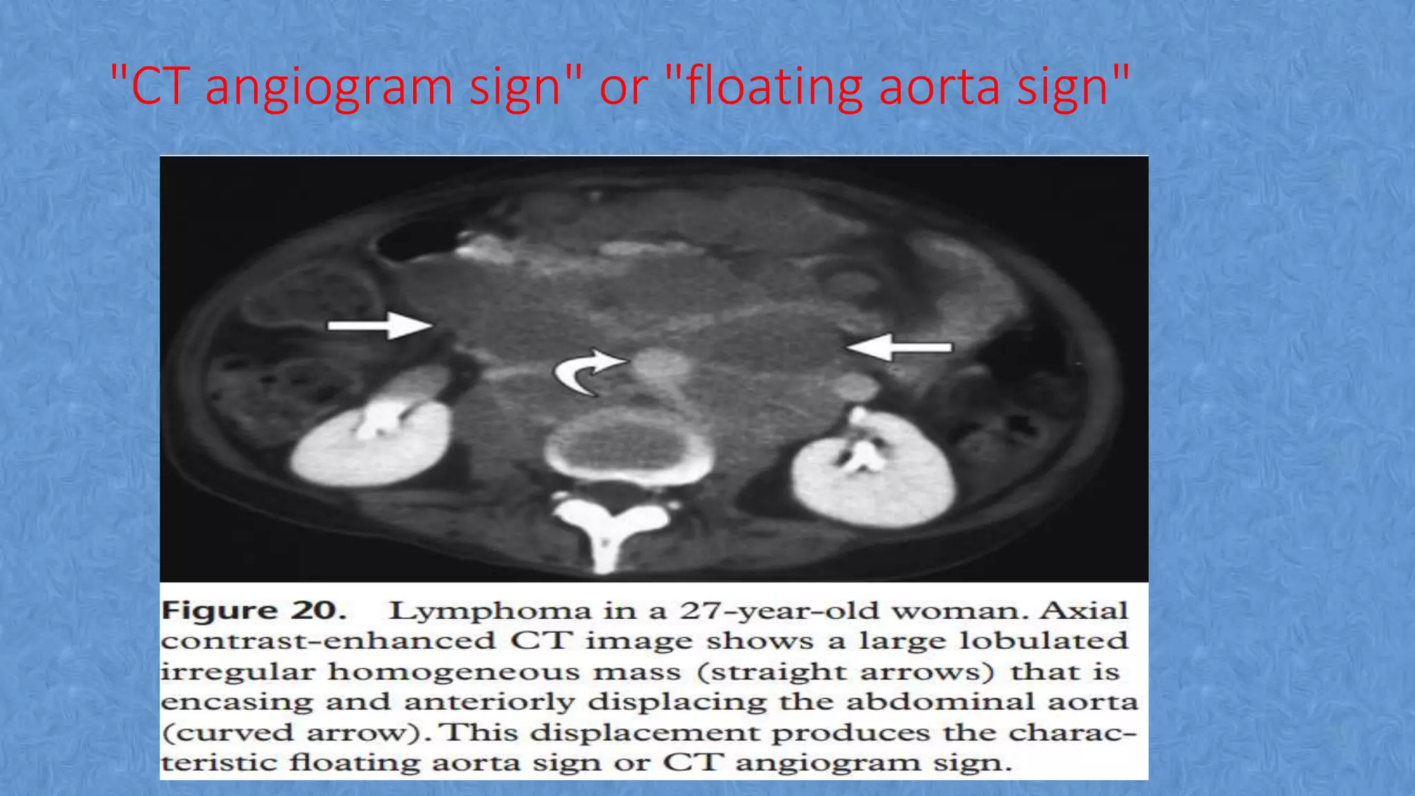 Retroperitoneal masses | PPTX