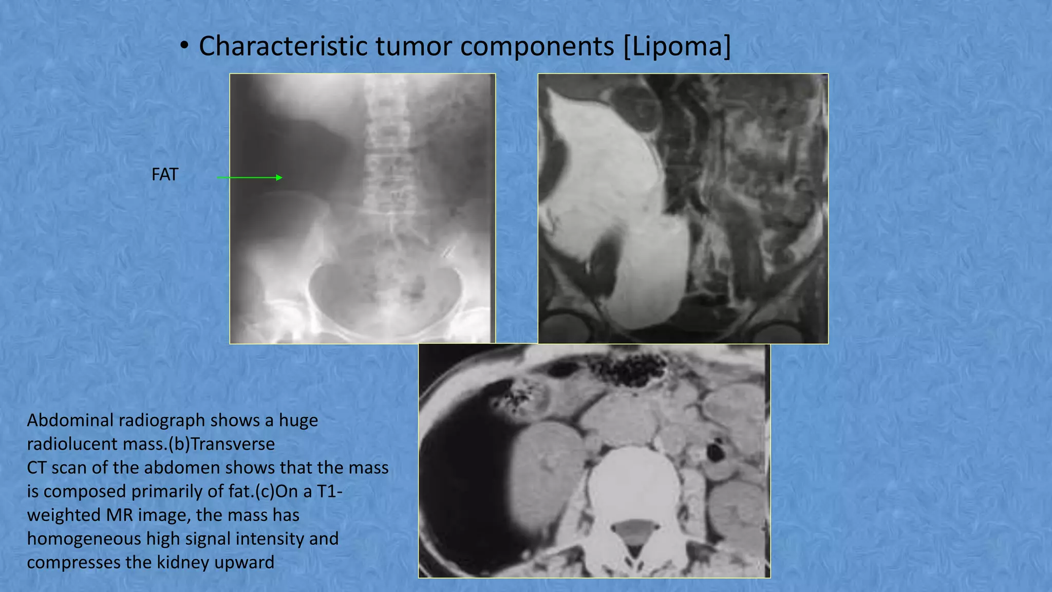 Retroperitoneal masses | PPTX