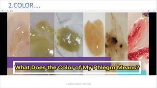 Rust Colored Sputum